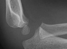 Adult elbow | Radiology Key