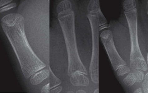Finger Radiographs