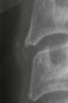 Cervical spine | Radiology Key