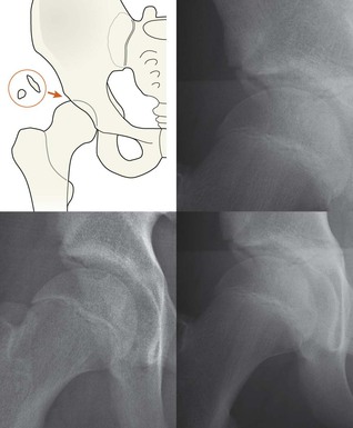 Hip & proximal femur | Radiology Key