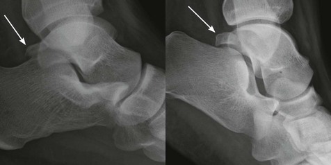 Ankle & hindfoot | Radiology Key