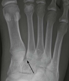 Midfoot & forefoot | Radiology Key