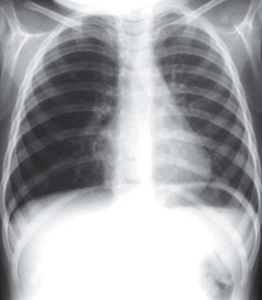 Chest | Radiology Key