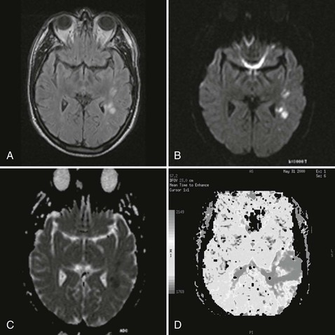 Diffusion Imaging | Radiology Key