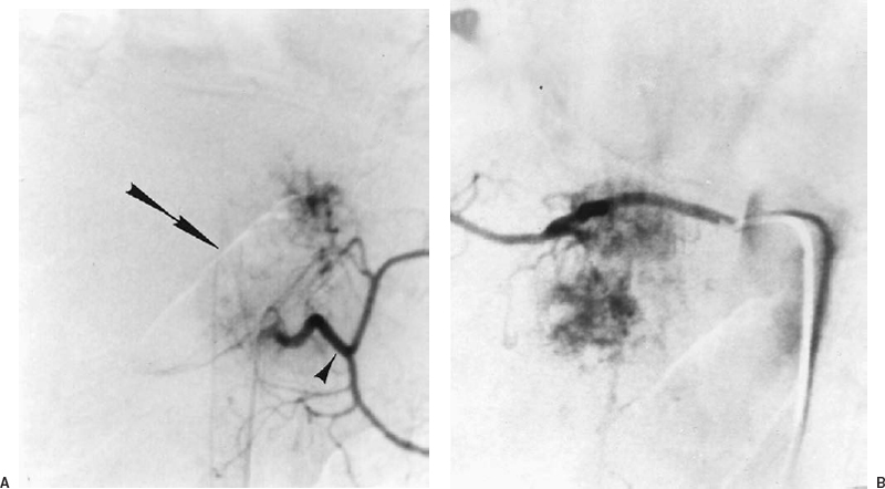 Carotid, Vertebral, and Spinal Arteriography | Radiology Key