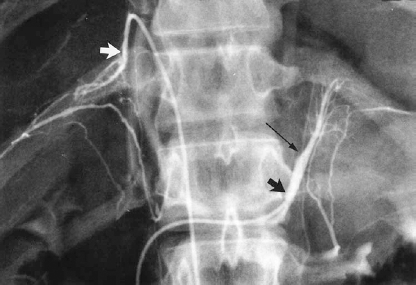 Arteriography and Venous Sampling of the Parathyroid Glands, Pancreas ...