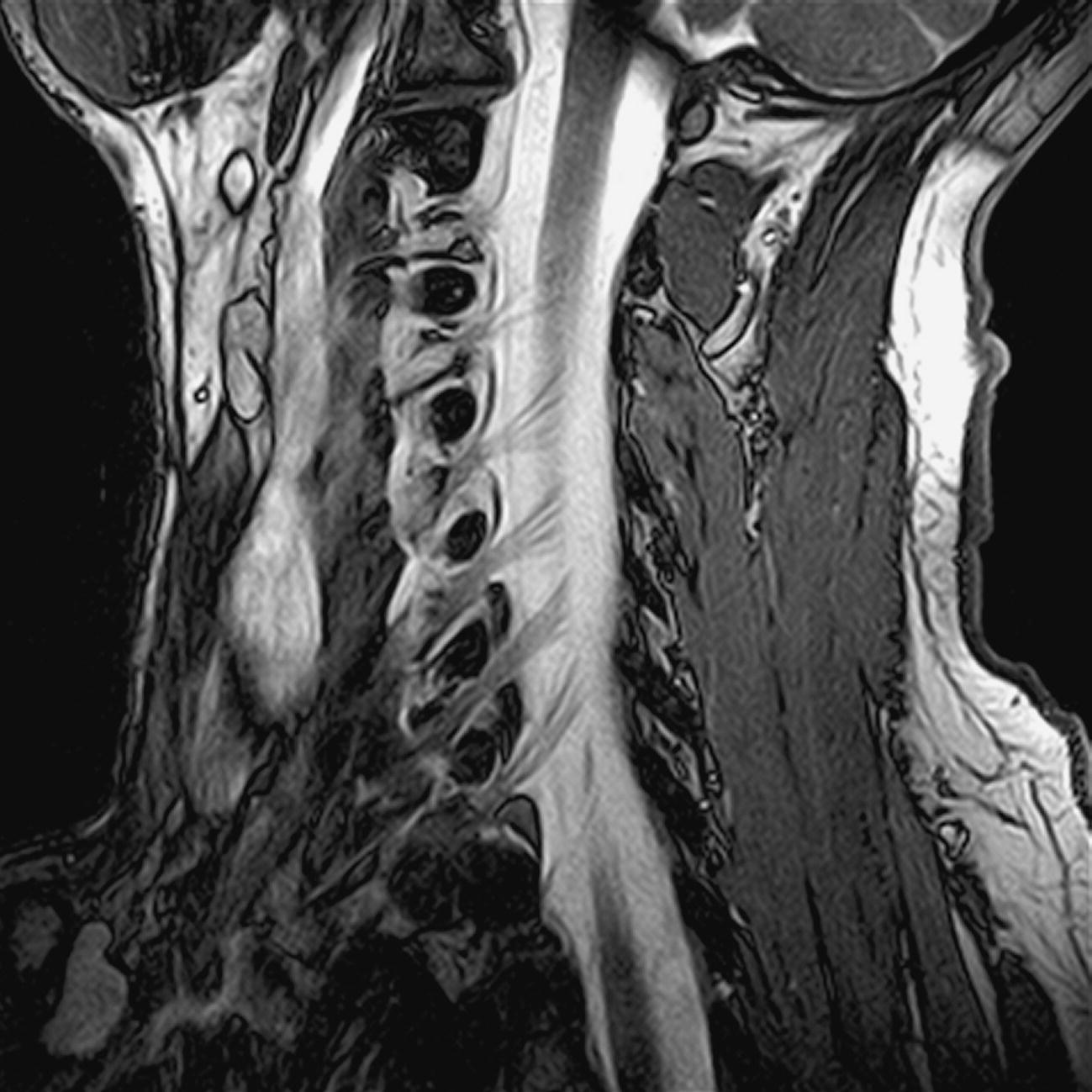 Spine | Radiology Key