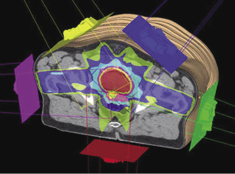 11: Radiation Treatment of Cancer | Radiology Key