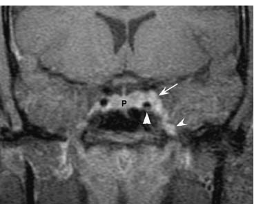 Abducens Nerve | Radiology Key