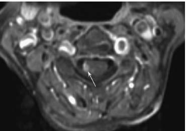 Accessory Nerve | Radiology Key