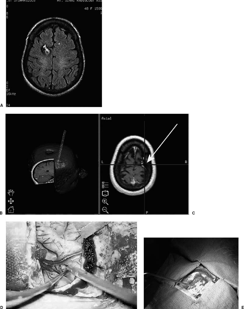 Cerebrovascular Applications of Image-Guided Surgery | Radiology Key