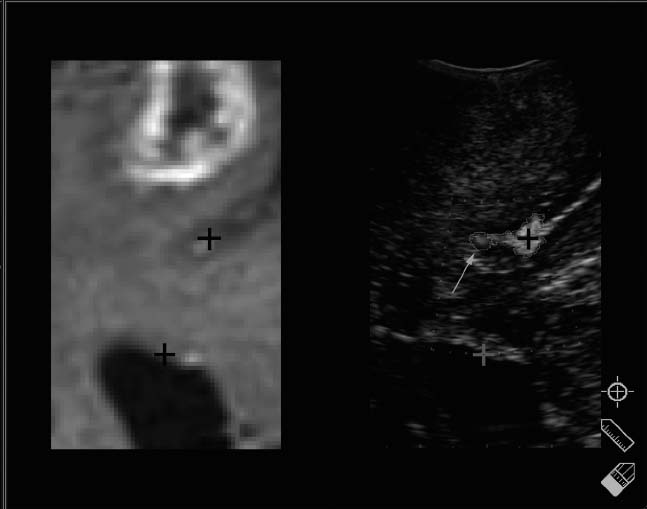 Intraoperative Image Update by Interface with Ultrasound | Radiology Key