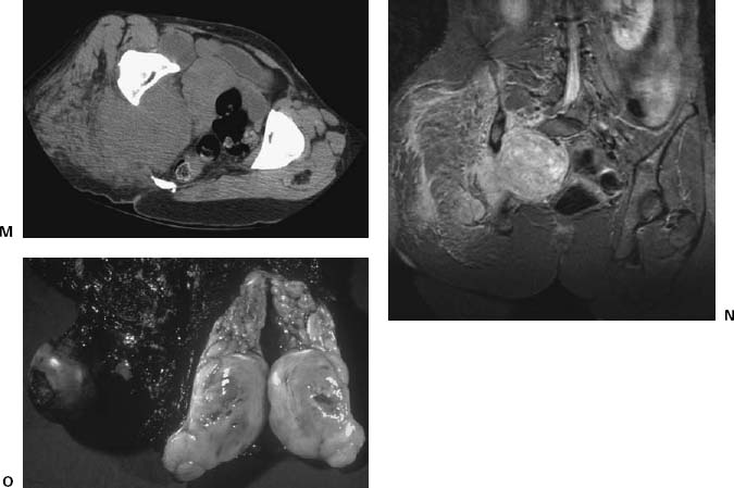 59 Neurofibroma | Radiology Key