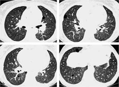 Idiopathic Interstitial Pneumonia | Radiology Key
