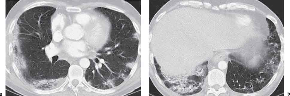 Infection and Inflammatory Disorders | Radiology Key