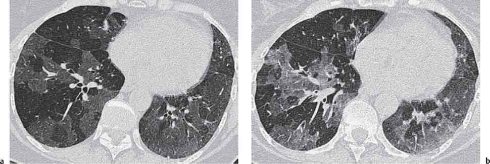 High-Resolution/Thin-Section CT Patterns in Pulmonary Disease ...