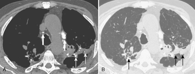 The Pneumoconioses | Radiology Key
