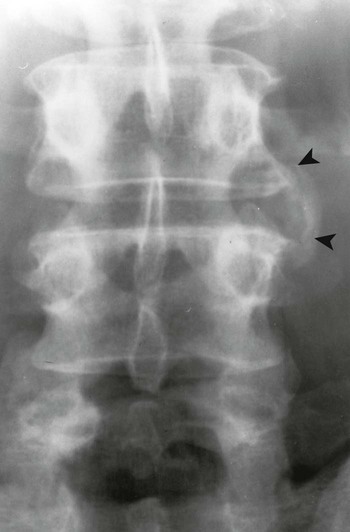 Arthritides | Radiology Key