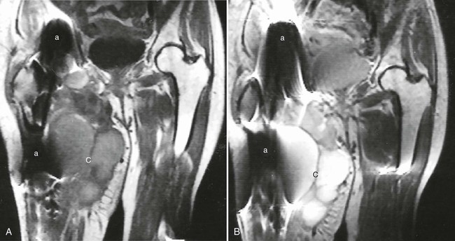 Bone Tumors and Related Diseases | Radiology Key