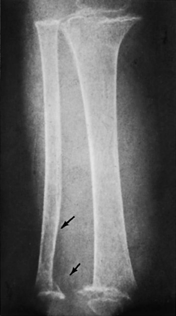 Extremity Patterns | Radiology Key