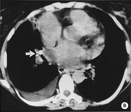 Large airway disease | Radiology Key