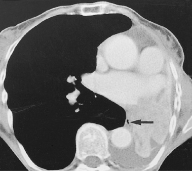 Pulmonary Lobar Collapse | Radiology Key