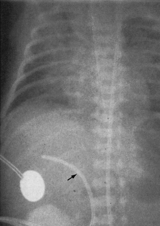 Pulmonary Lobar Collapse | Radiology Key