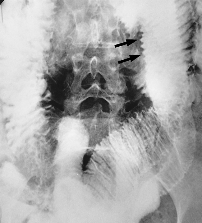 Small bowel | Radiology Key