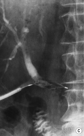 Biliary | Radiology Key