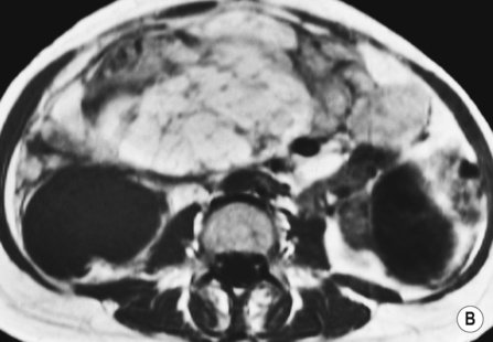 Peritoneum, mesentery and omentum | Radiology Key