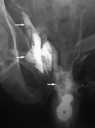 Bladder | Radiology Key