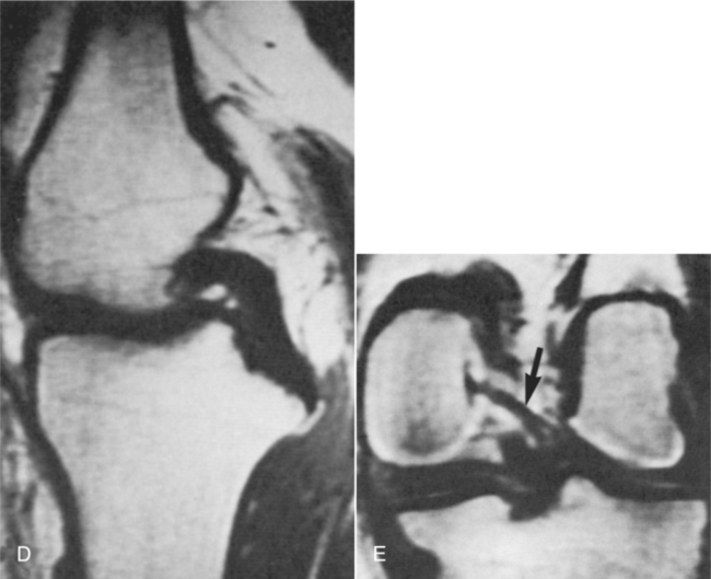Arthrography | Radiology Key