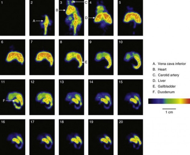 Tomographic Reconstruction in Nuclear Medicine | Radiology Key