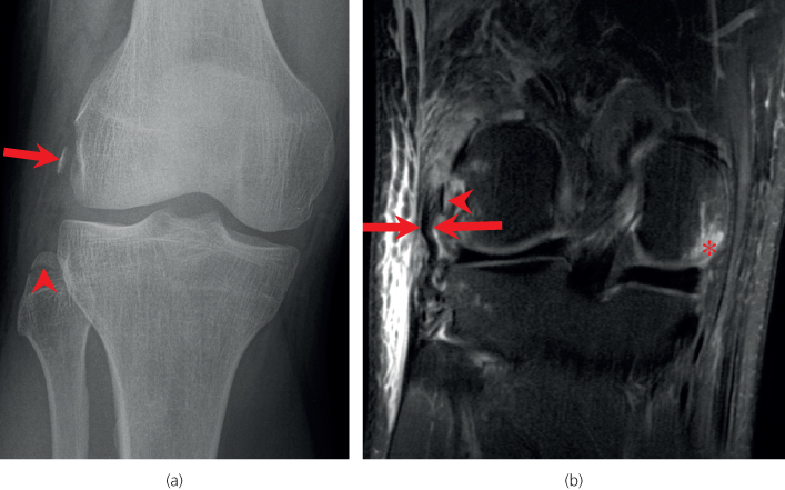 Knee | Radiology Key