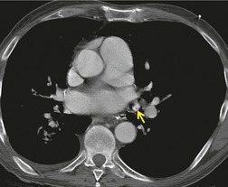 8. Inhalational lung disease | Radiology Key