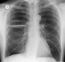 7. Pulmonary vascular diseases and pulmonary edema | Radiology Key