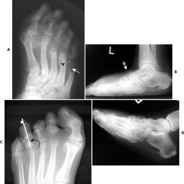 9. Arthritides | Radiology Key