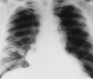 27. Chest Patterns | Radiology Key