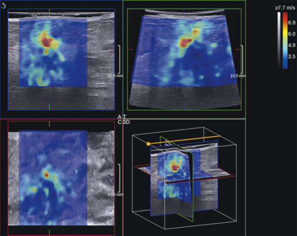 Principles of Elastography | Radiology Key