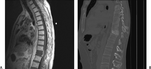 Treatment of Spinal Canal Compromise | Radiology Key