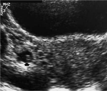 Amenorrhea in the Adolescent or Young Adult | Radiology Key