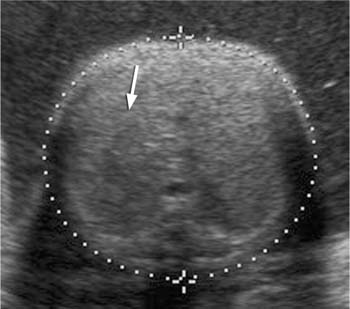 Pregnant Women with High Maternal Serum–Alpha-Fetoprotein | Radiology Key