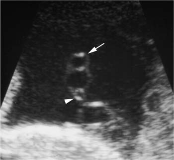 Postpartum Complications Radiology Key