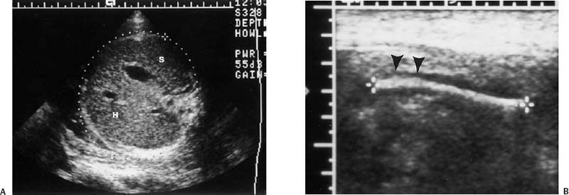 Teratogen Exposure | Radiology Key