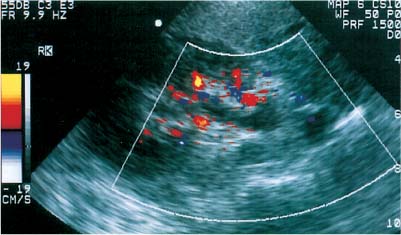 Flank Pain | Radiology Key
