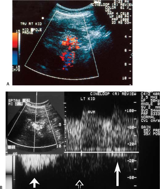 Hypertension and Bruit | Radiology Key