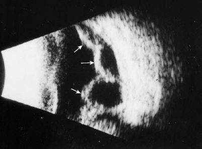 The Choroid | Radiology Key