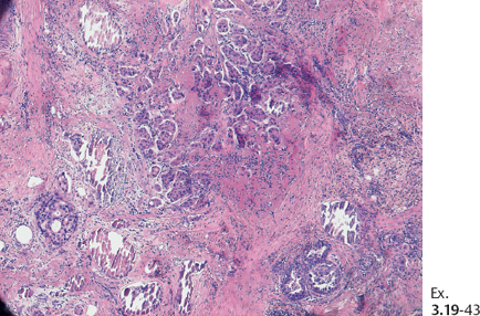 Multiple Clusters of Crushed Stone-like Calcifications on the Mammogram ...