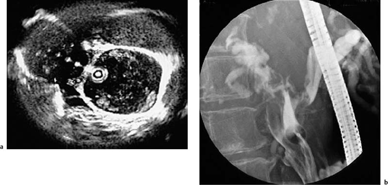 Intraductal Ultrasound | Radiology Key