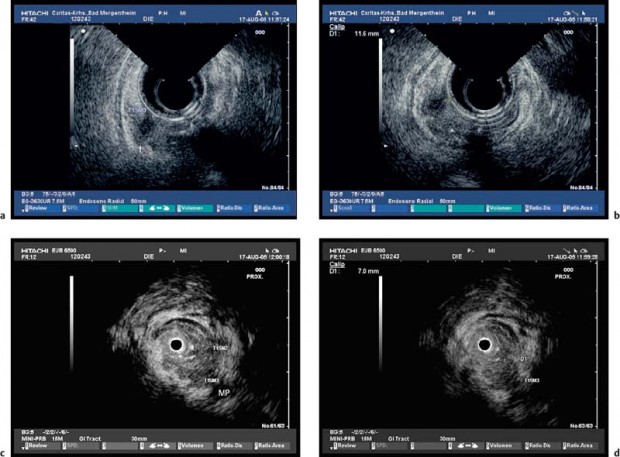 Endoanal and Endorectal Sonography | Radiology Key